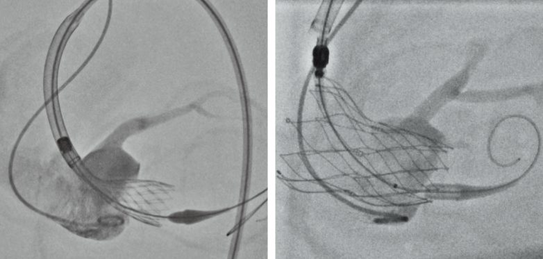 Modelo horizontal TAVI | HEARTROID
